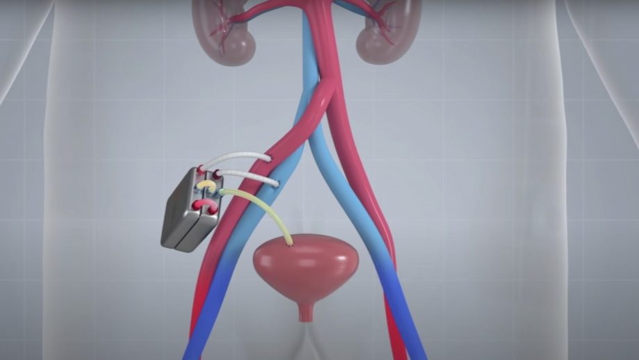 artificial kidney Archives - Nerdist